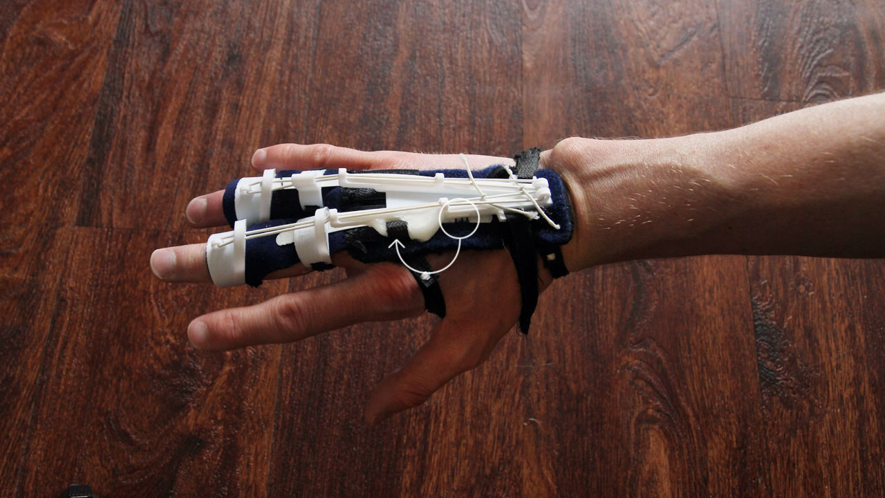 3D printing hand exoskeleton | Patient Innovation