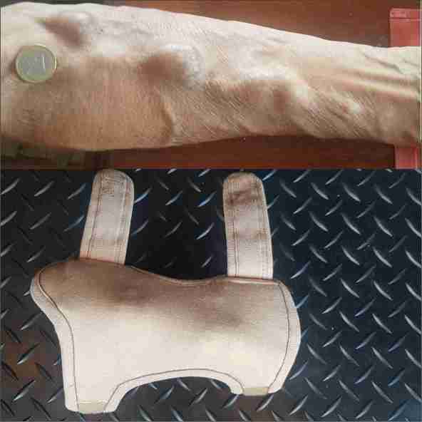 A personalized AV fistula protection for dialysis patients. | Patient ...