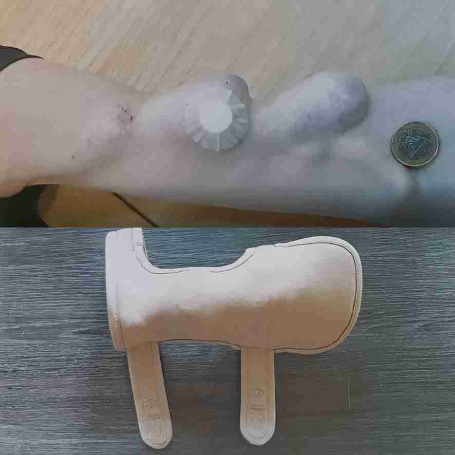 A personalized AV fistula protection for dialysis patients. | Patient ...