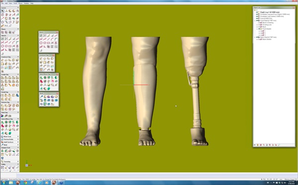 Custom 3D printed prosthetics | Patient Innovation