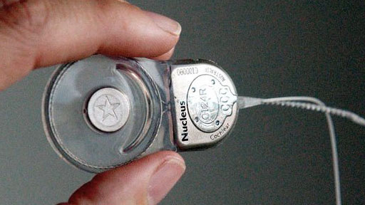 Professor Graeme Clark invented the Cochlear Implant | Patient Innovation