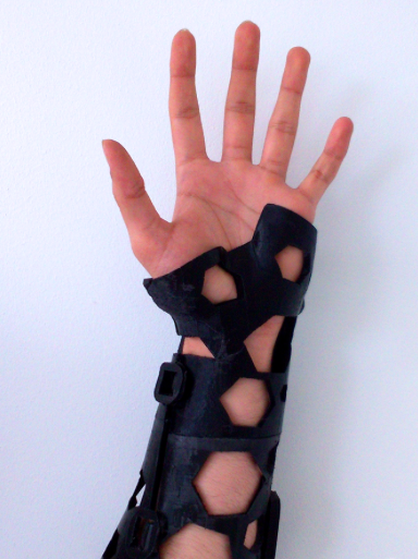Man invents 3D printed cast for his mother | Patient Innovation