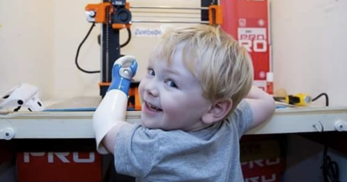 Father creates a bionic limb for his baby son using Xbox scanner and 3D ...