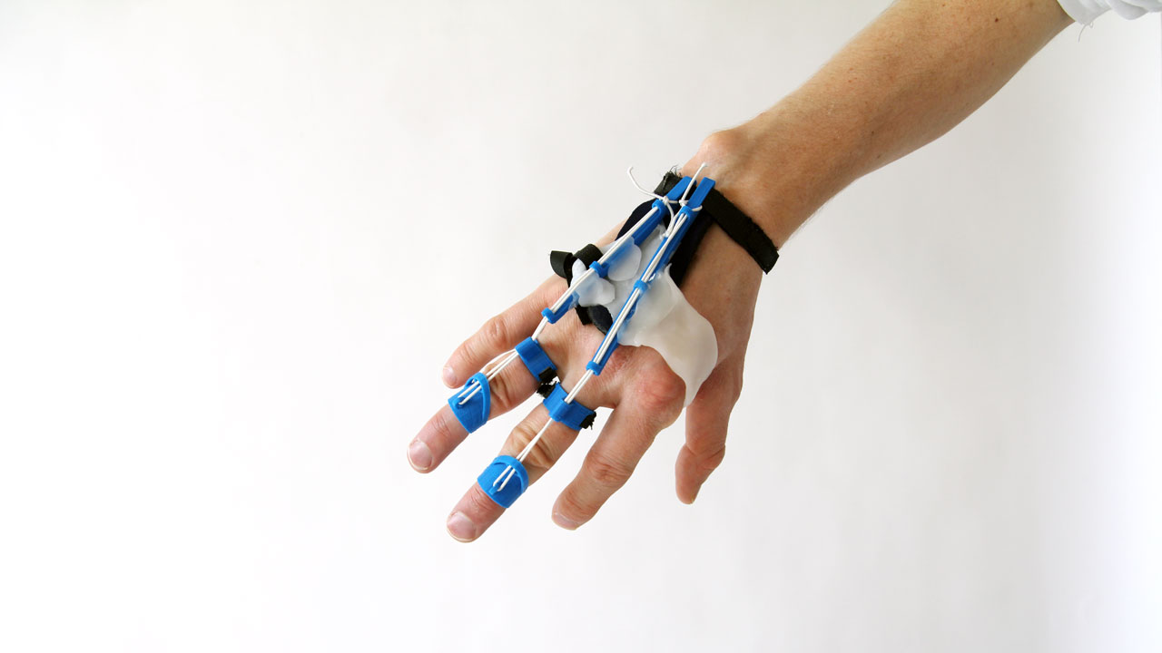 3D printing hand exoskeleton | Patient Innovation